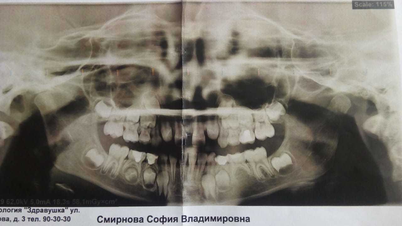 Мешает расти передним зубам | Пикабу
